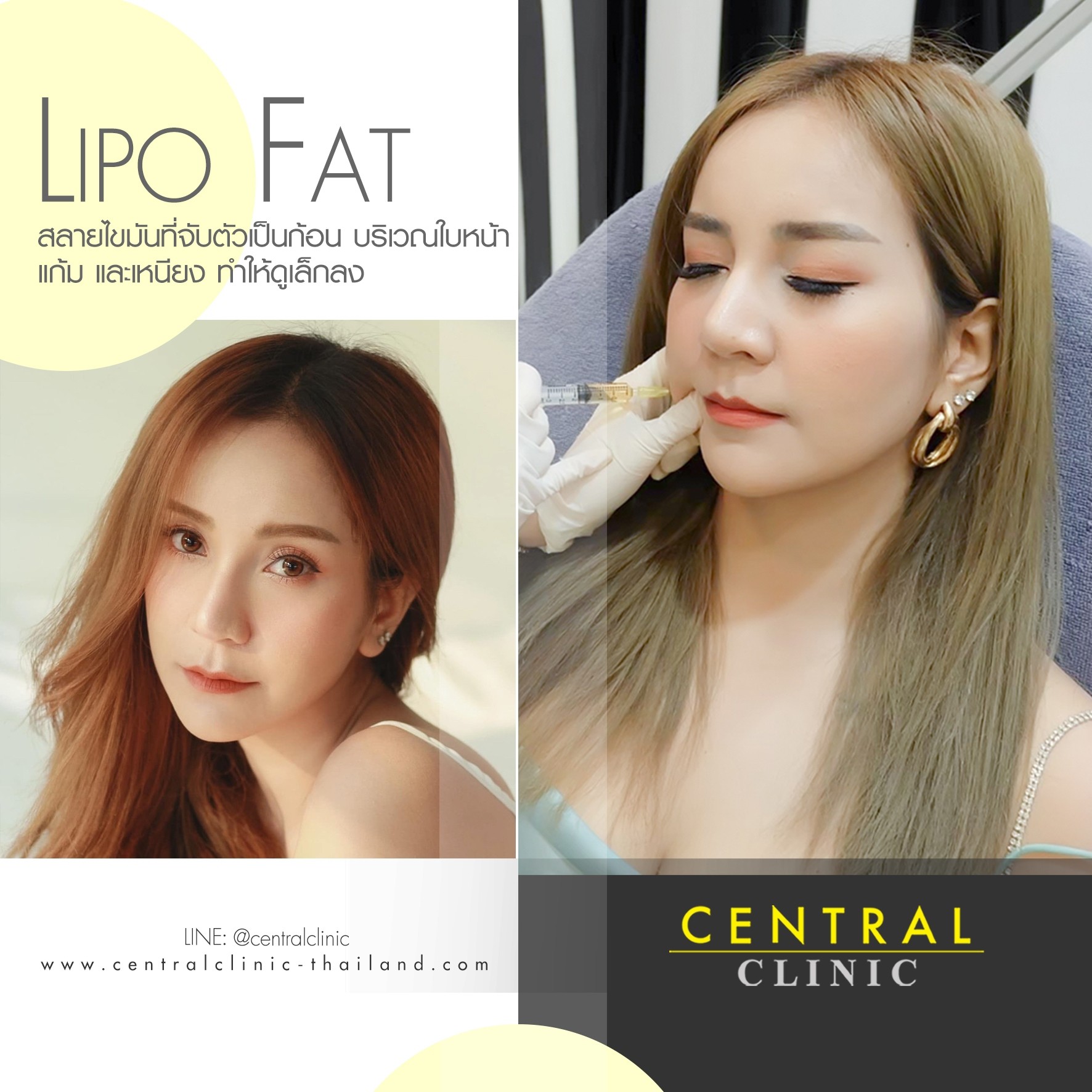 Lipo Fat 1 เข็ม | Central Clinic