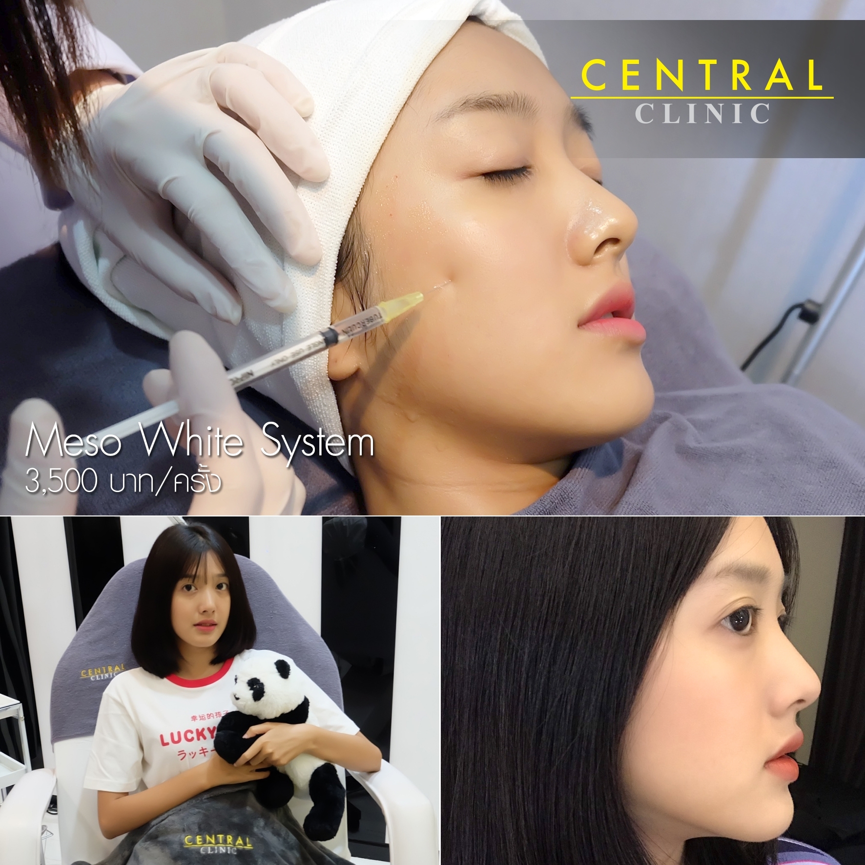 Meso White System 1 ครั้ง | Central Clinic