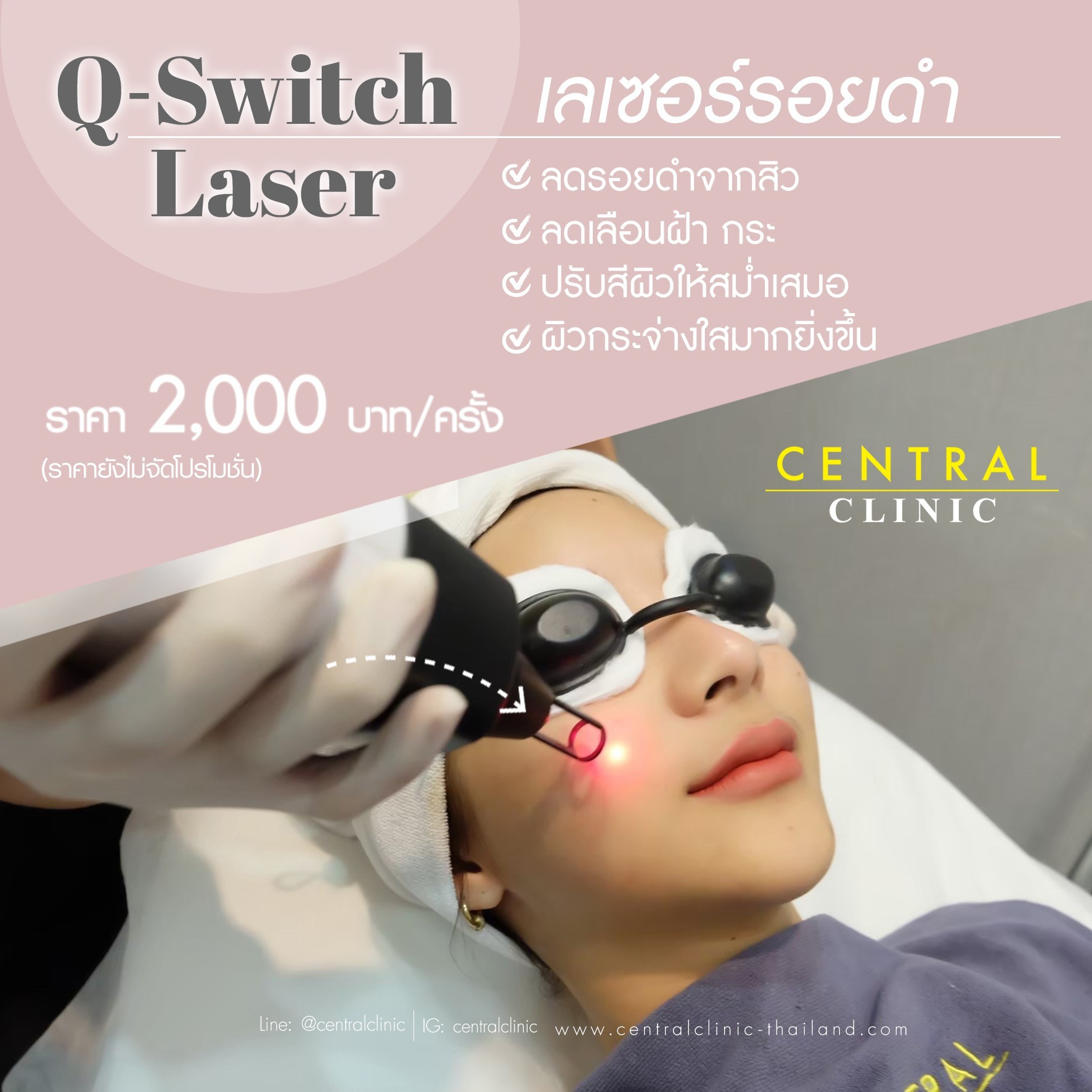Q-Switch Laser | Central Clinic