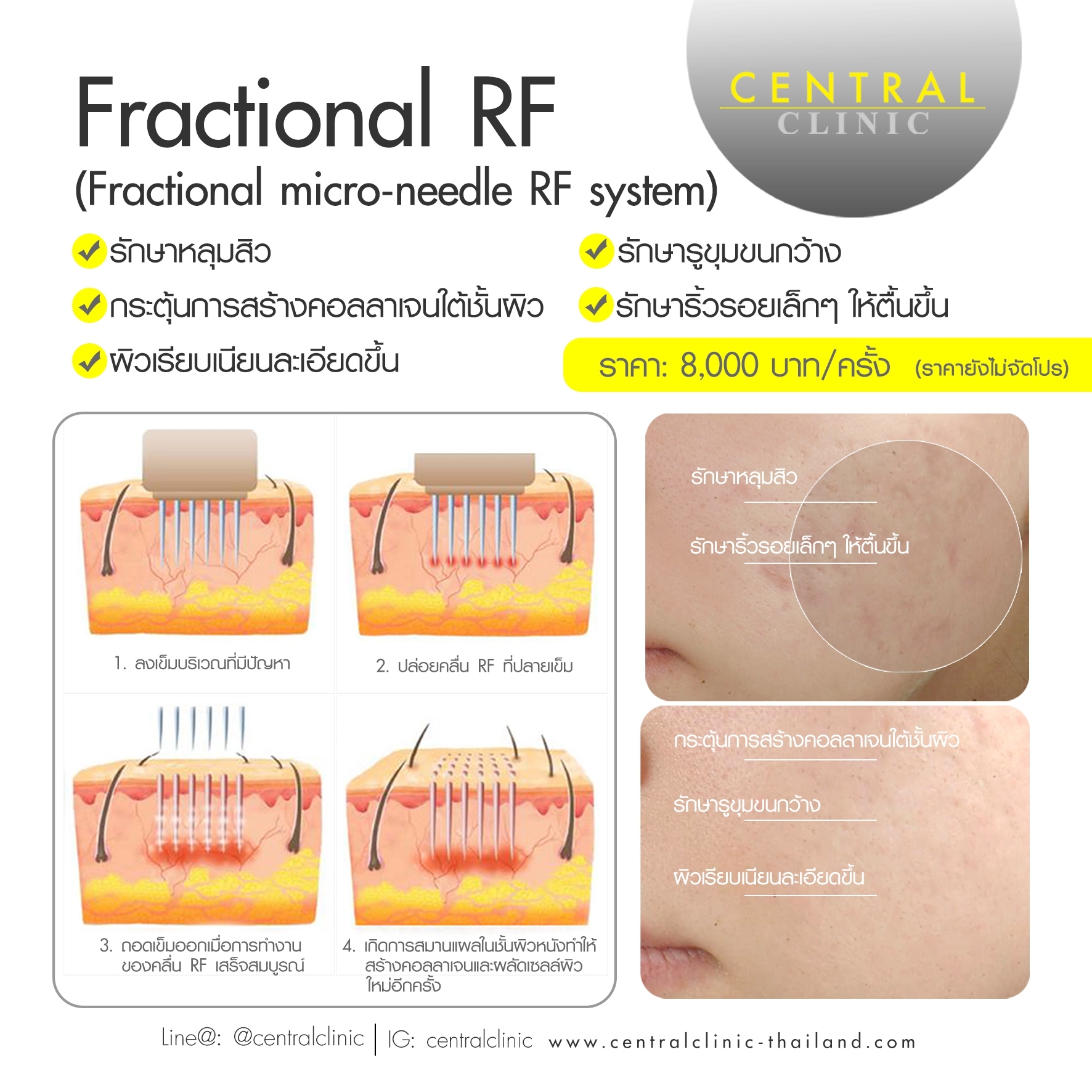 Fractional RF รักษาหลุมสิว ซื้อ 1 แถม 1 | Central Clinic