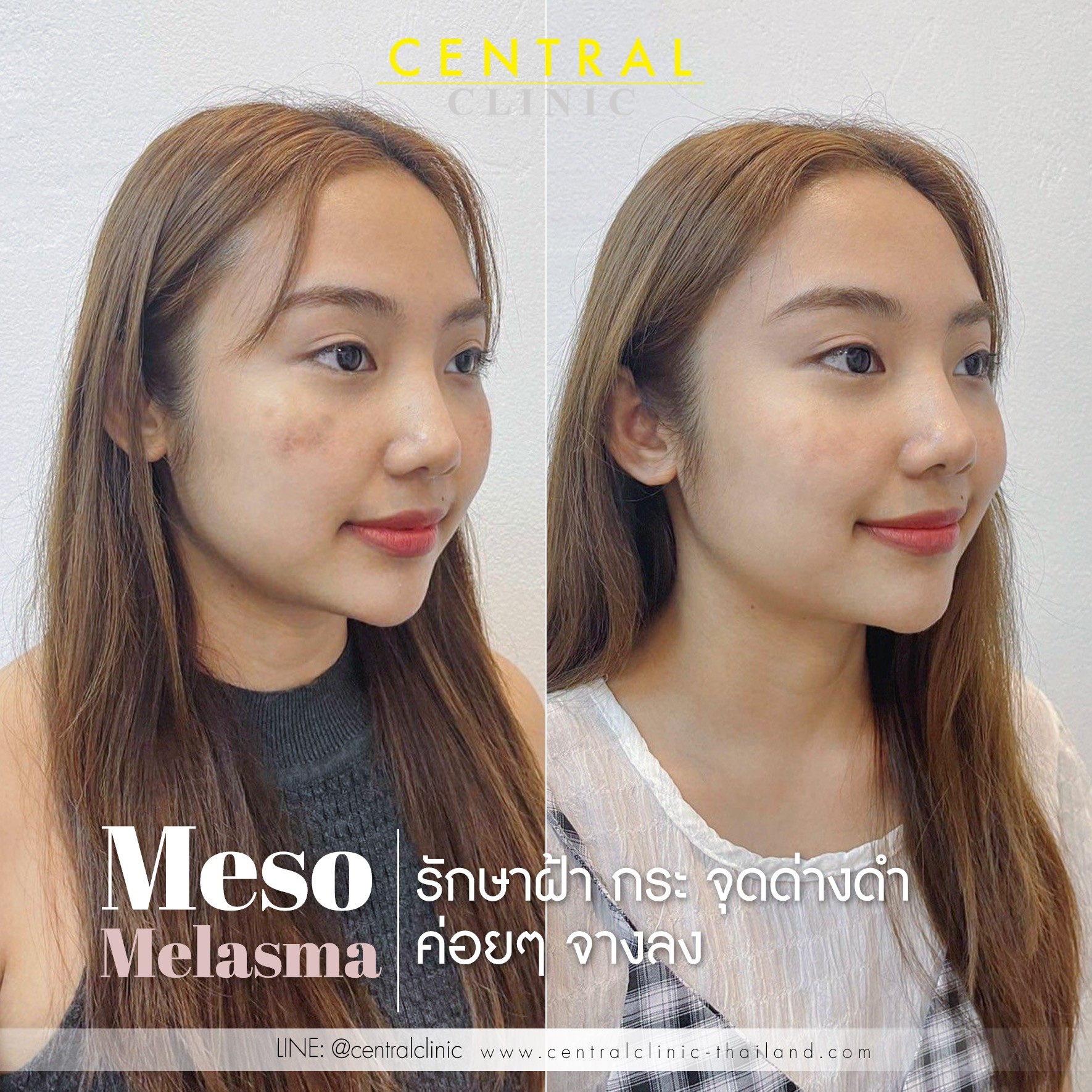 Meso Melasma 1 เข็ม | Central Clinic